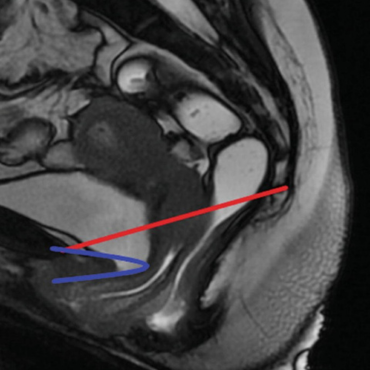 MRI Defecography - starsuratpiles
