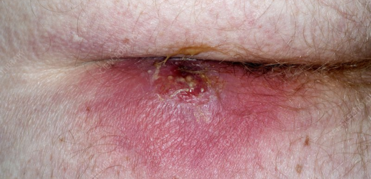 Perianal Abscess - starsuratpiles